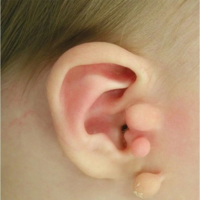 preauricular region